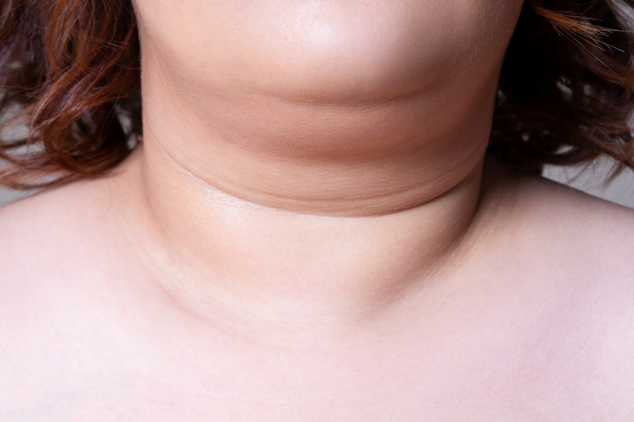 Why Neck Fat Happens & How to Reduce It Effectively